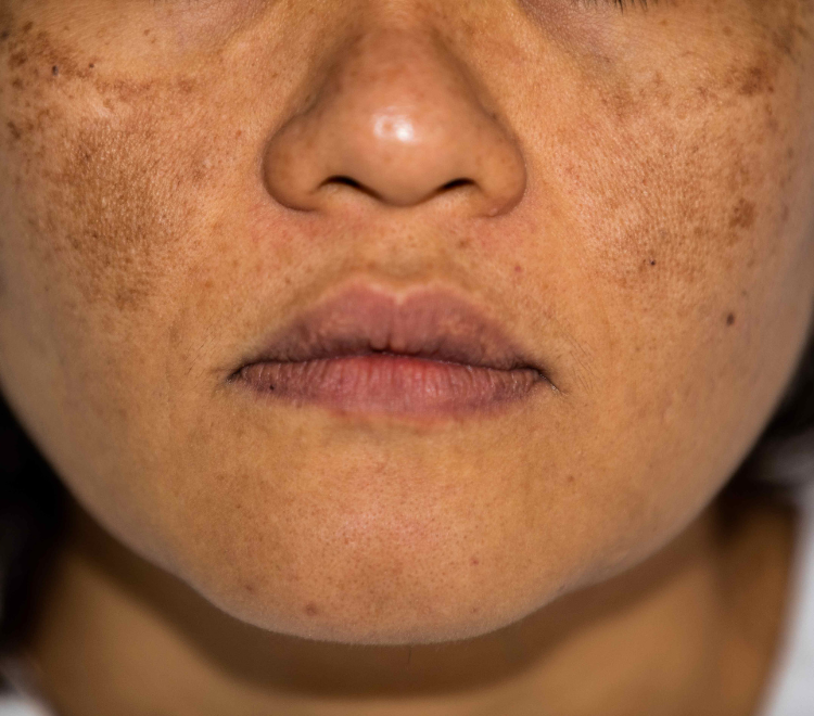 Melasma On Face — Articles — We Care For Skin