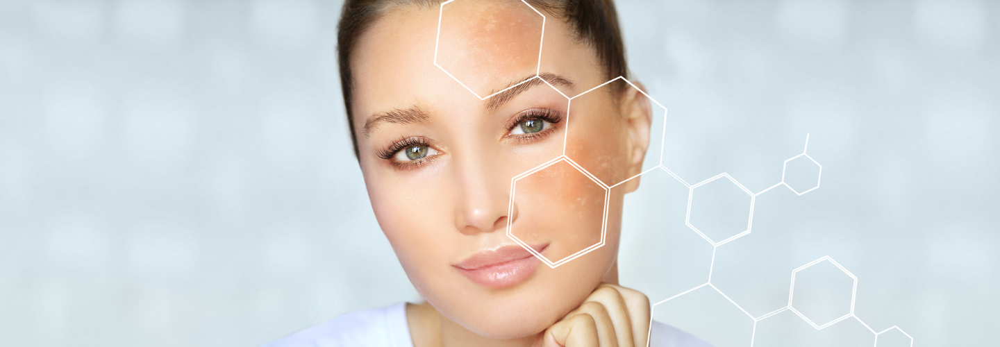 Melasma as One of the Common Diseases in Summer — Articles — We Care ...