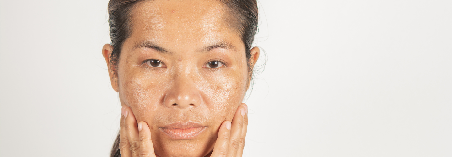 Pekas 101: How To Treat It — Articles — We Care For Skin